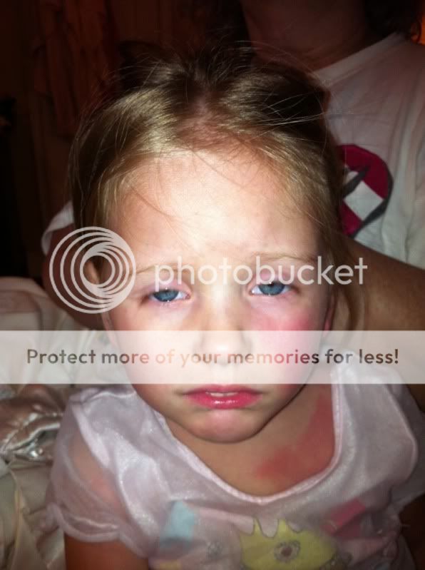 Coconut Allergy Symptoms Baby at Patty Armbruster blog